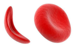 Anemia Falciforme: Cos'è? Sintomi, Cause, Diagnosi e Terapia