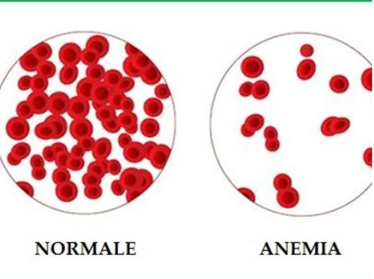 RDW Basso, Alto: Cosa Significa? RDW SD e RDW CV