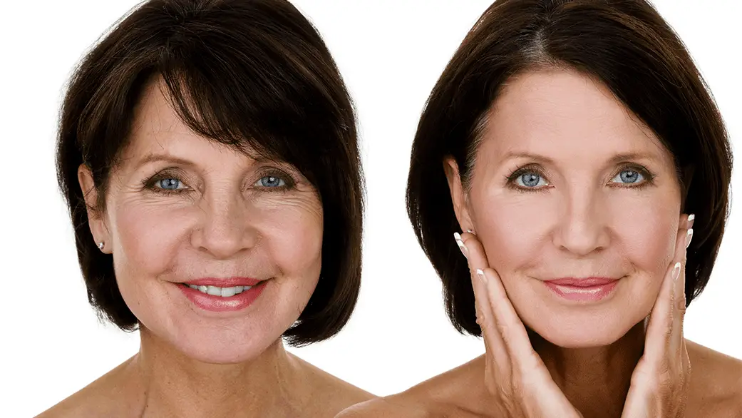 Lipofilling: cos’è, come funziona e quali sono i costi? - Non solo diete